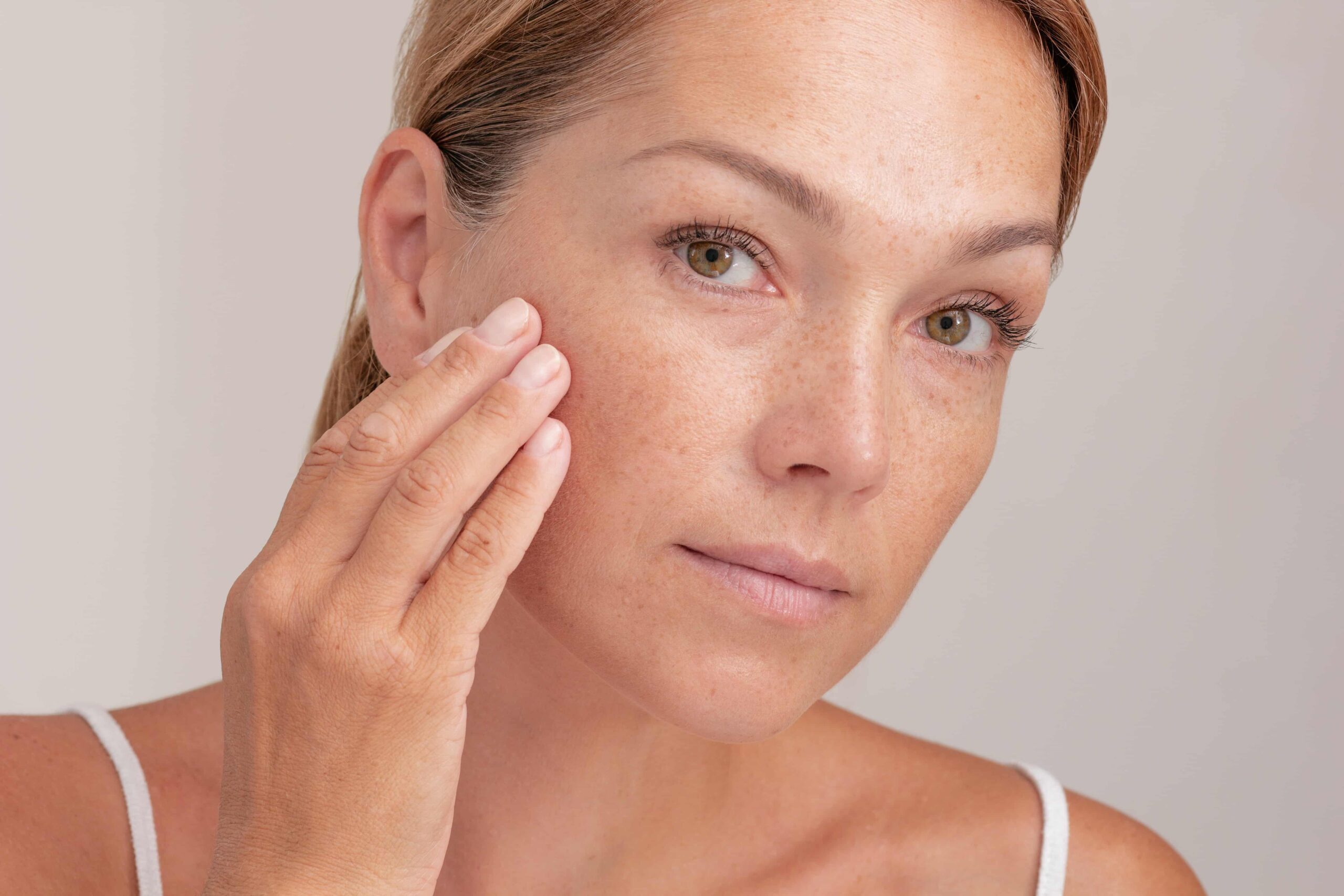 Hyperpigmentation, Dark Spots & Melasma - Supriya Dermatology
