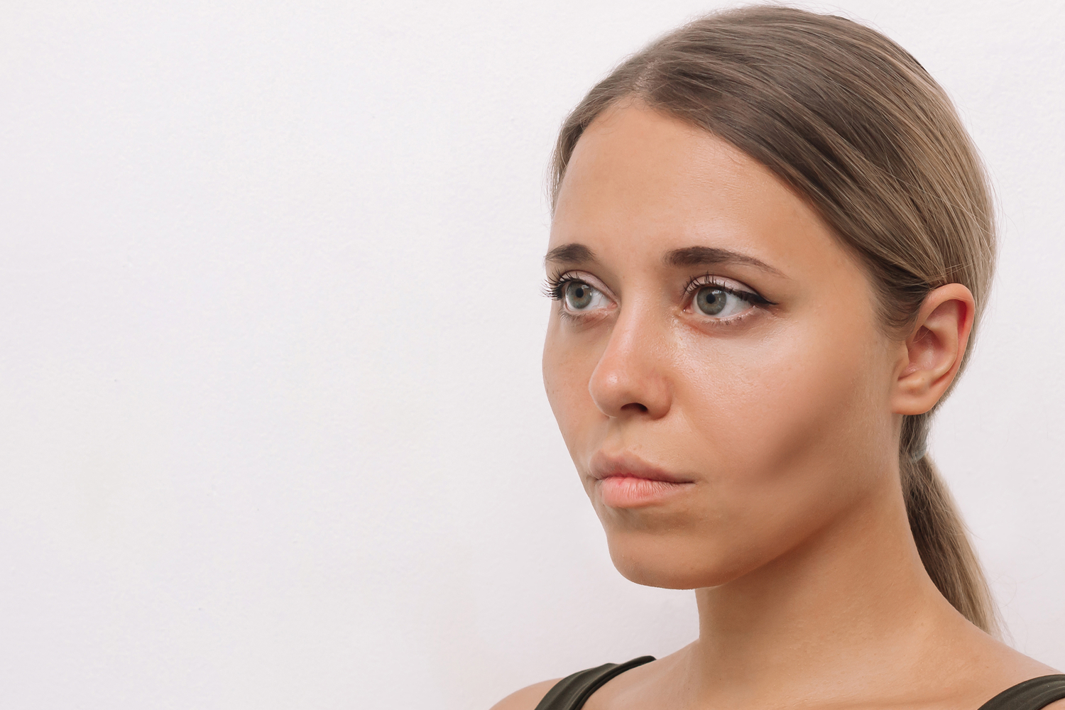 Hollow Cheeks + Facial Volume Loss - Supriya Dermatology
